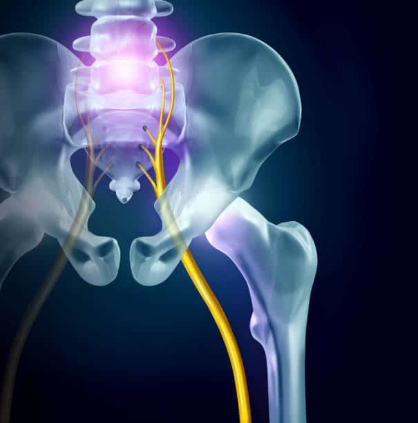 Sciatica Relief Services in Houston & Woodlands, TX